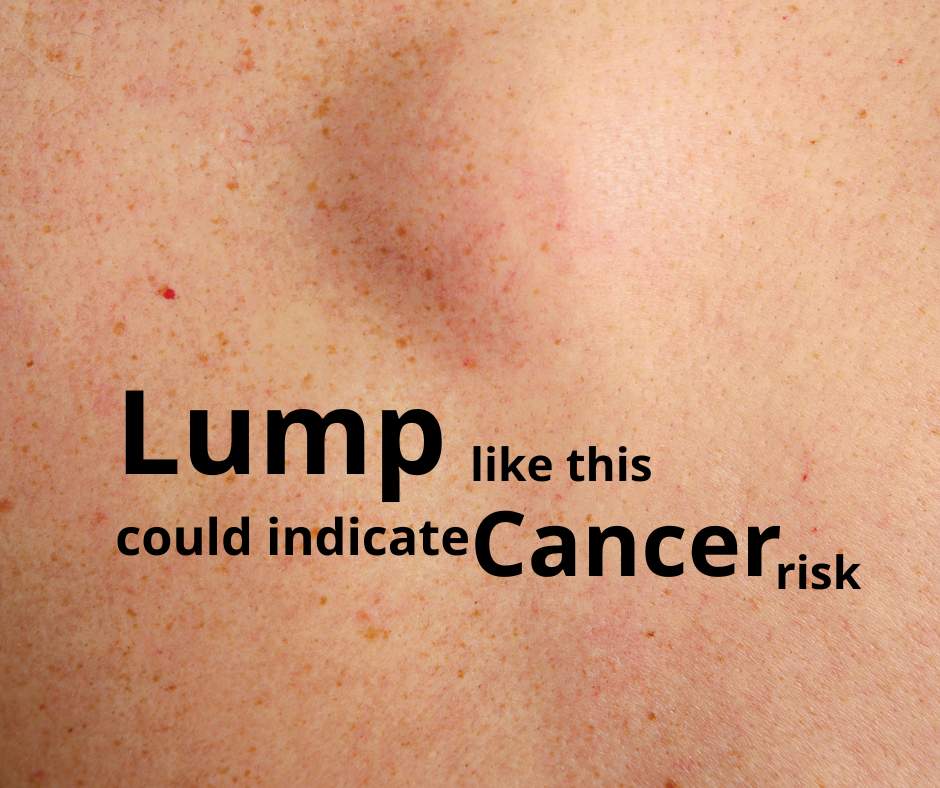 Lumps Like This Could Indicate Cancer Risk! - หมอโป้ง คุยเฟื่องเรื่องกระดูก